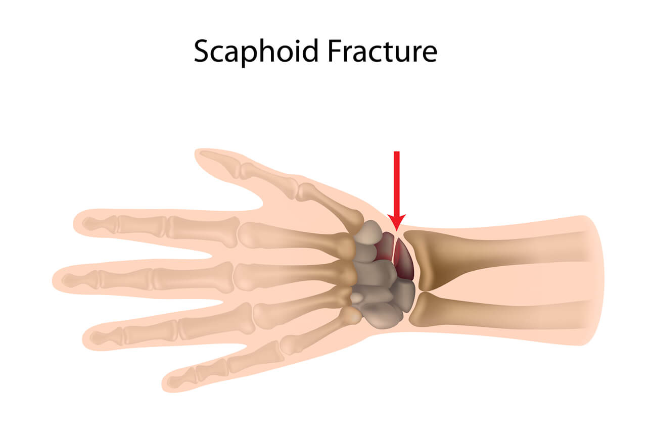Fractures and Dislocations - FORM Hand Therapy